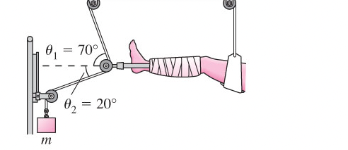 Solved Patients with severe leg breaks are often placed in | Chegg.com