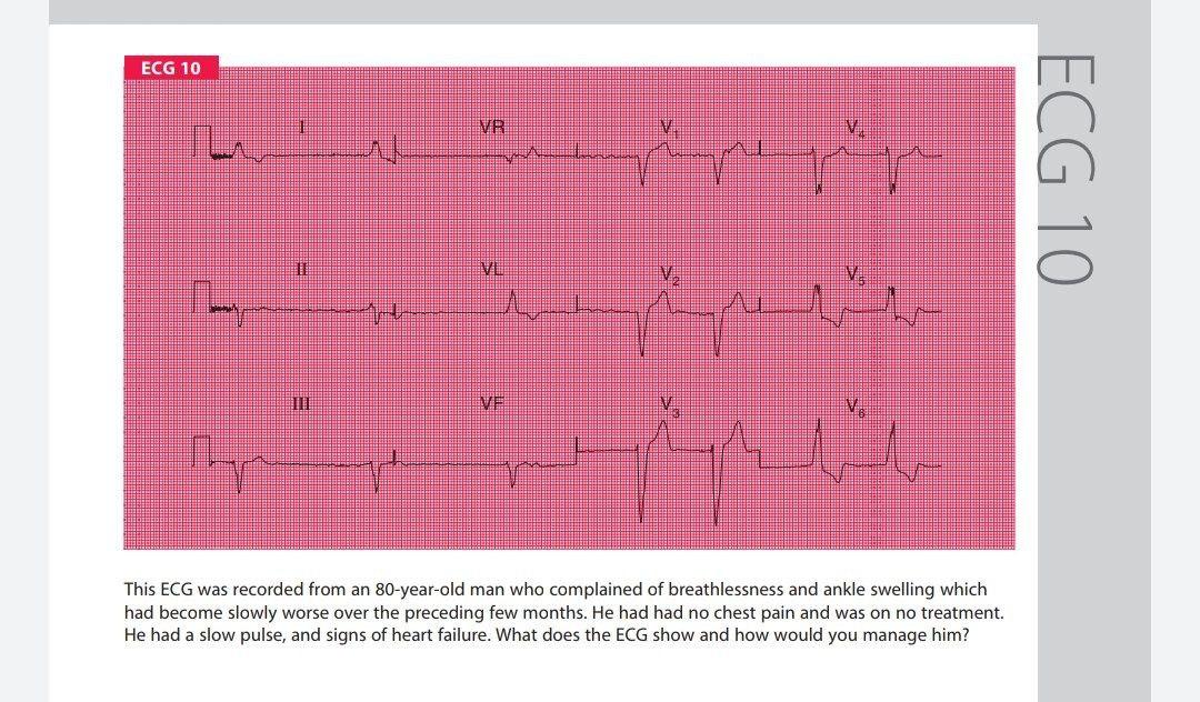 Solved ECG 10 VR V V BURE ECG 10 II Vi V. V: III VE V V. | Chegg.com