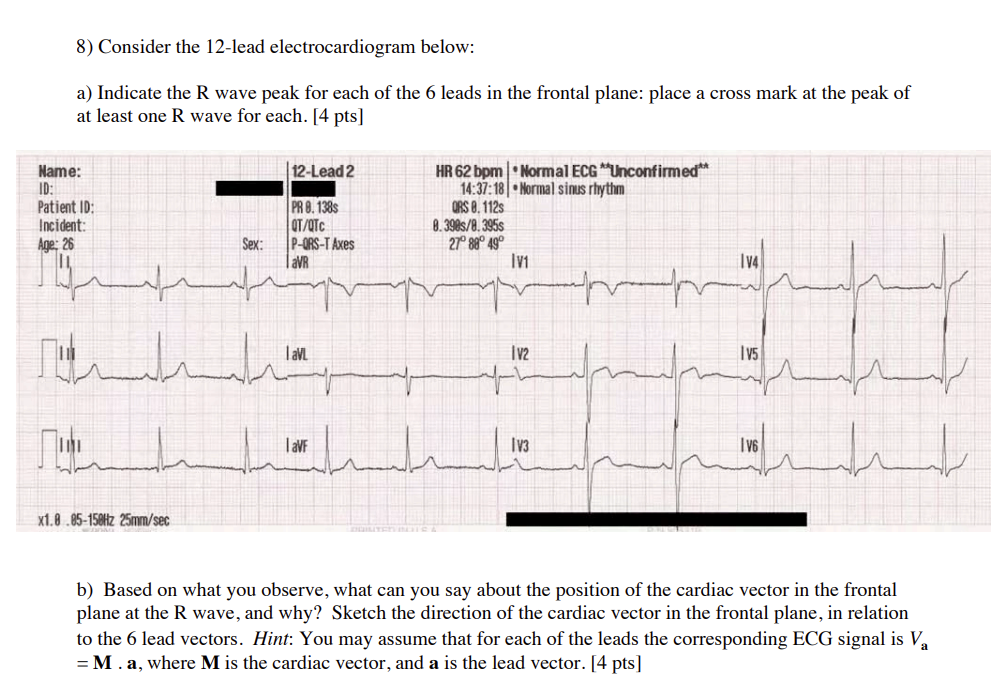 Solved 8) Consider the 12-lead electrocardiogram below: a) | Chegg.com