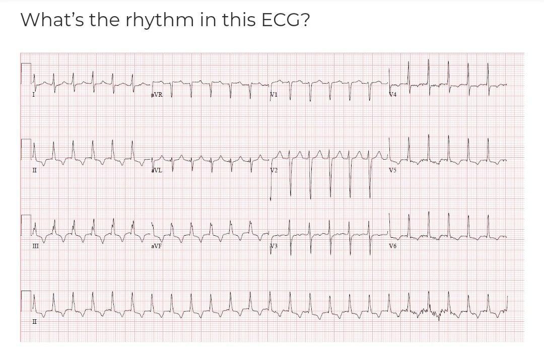 Solved What's the rhythm in this ECG? للمال امام سلام AVR N1 | Chegg.com