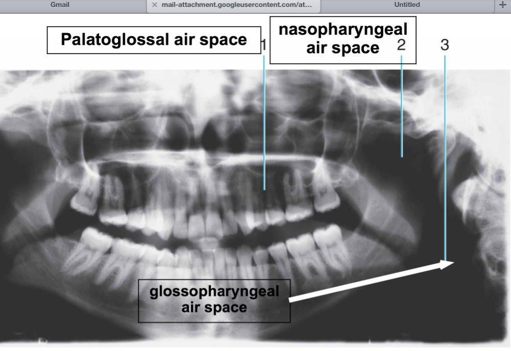 Nasopharyngeal Air Space
