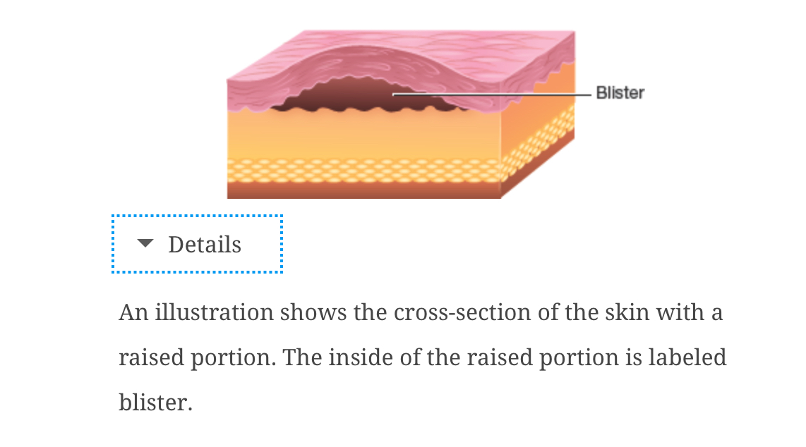 Solved This image shows a blister, a fluid-filled skin | Chegg.com