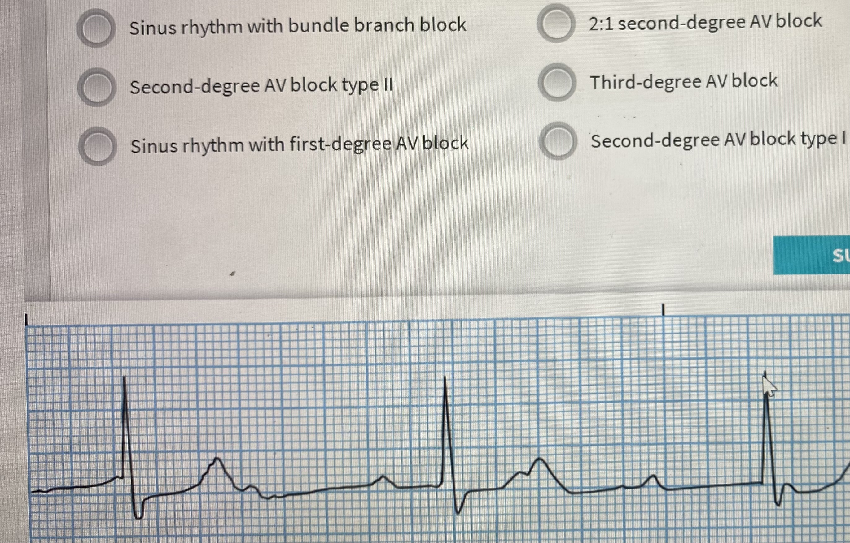 Solved Sinus rhythm with bundle branch block Second-degree | Chegg.com