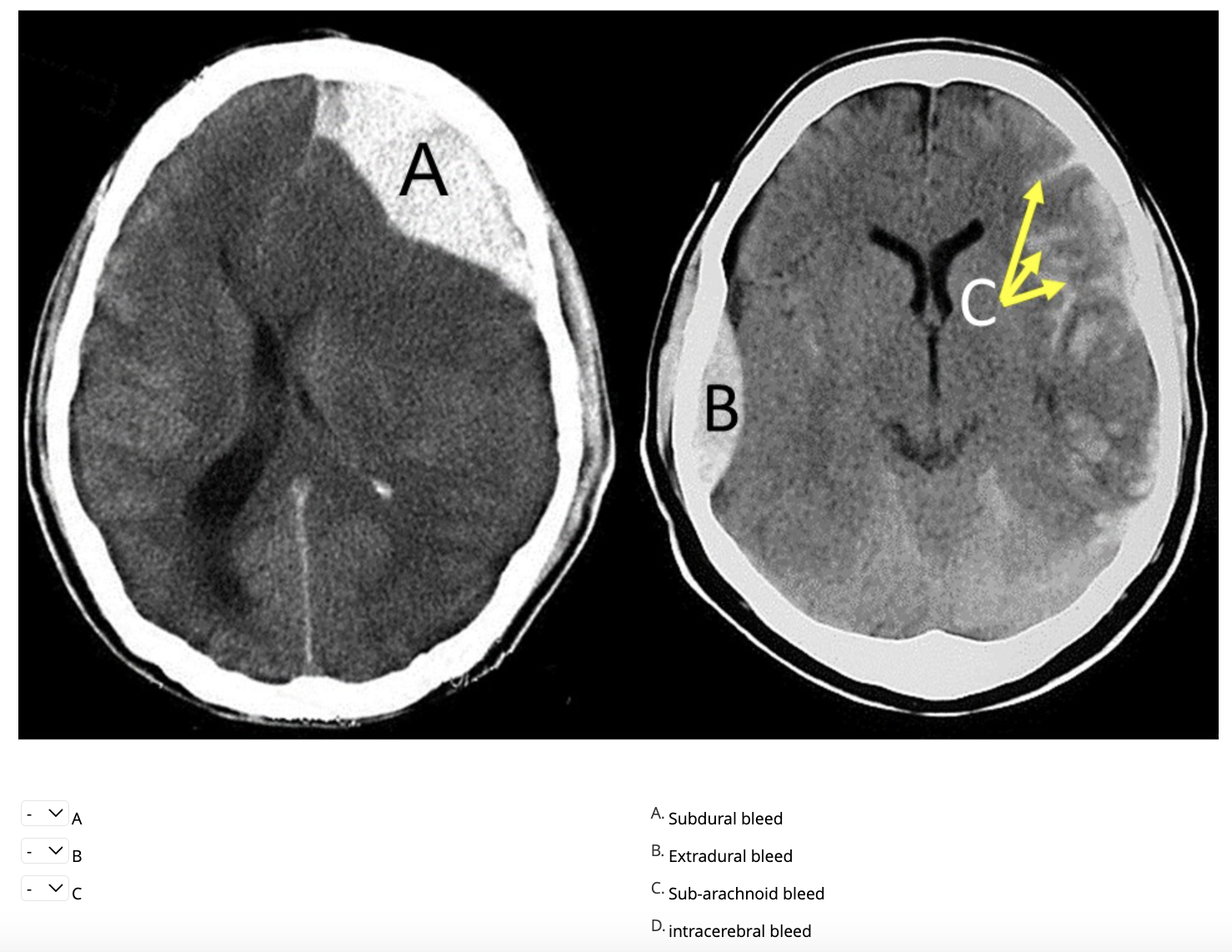 Solved Name the vascular lesion indicated by the letters A-C | Chegg.com