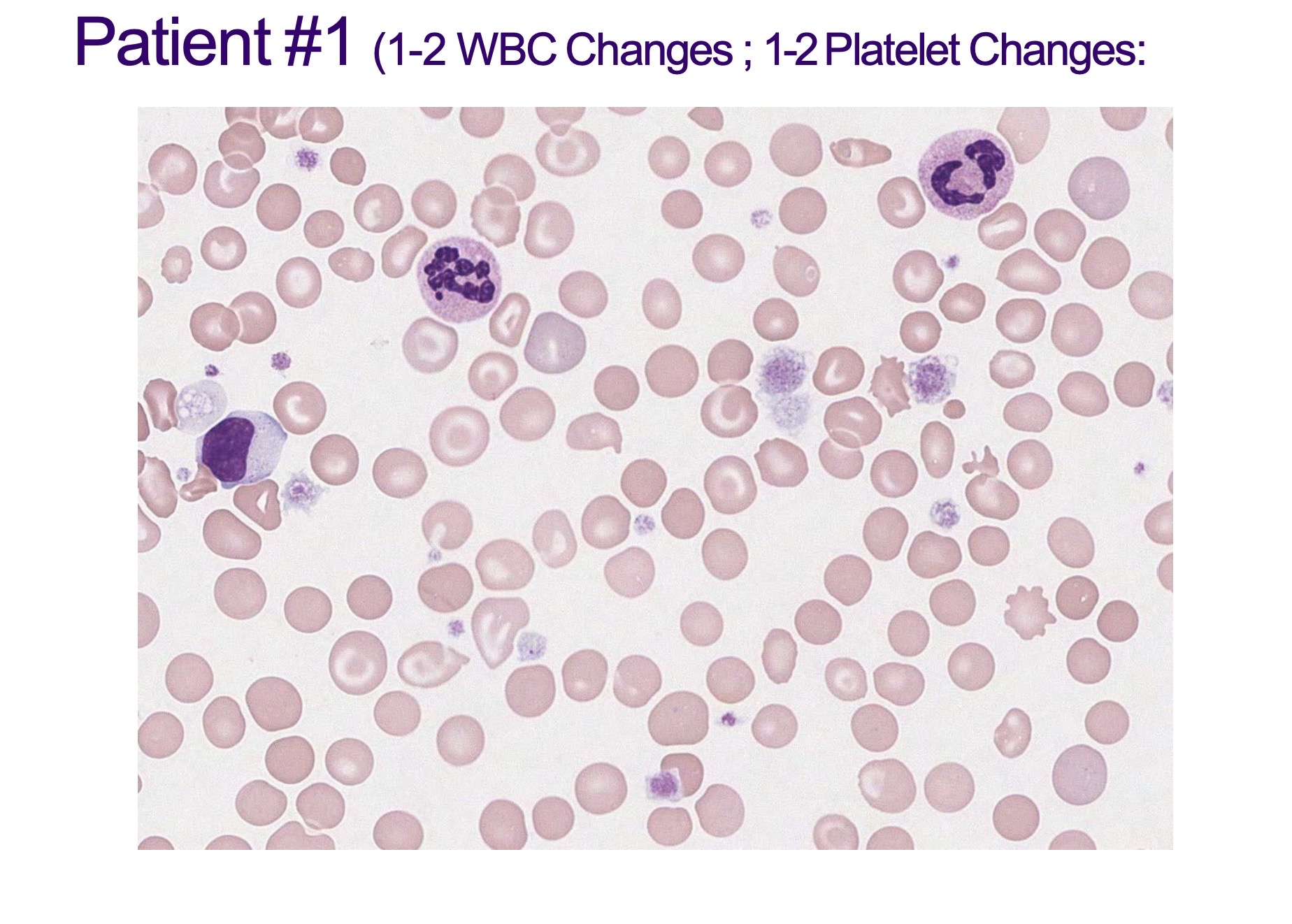 Solved Patient \#1 (1-2 WBC changes; 1-2 Plt changes) Age: | Chegg.com