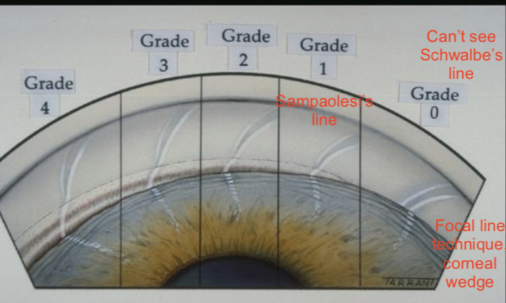 Gonioscopy Corneal Wedge