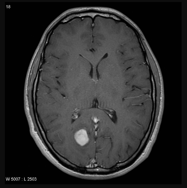 Solved Design A Matlab Program To Detect A Brain Tumor In An