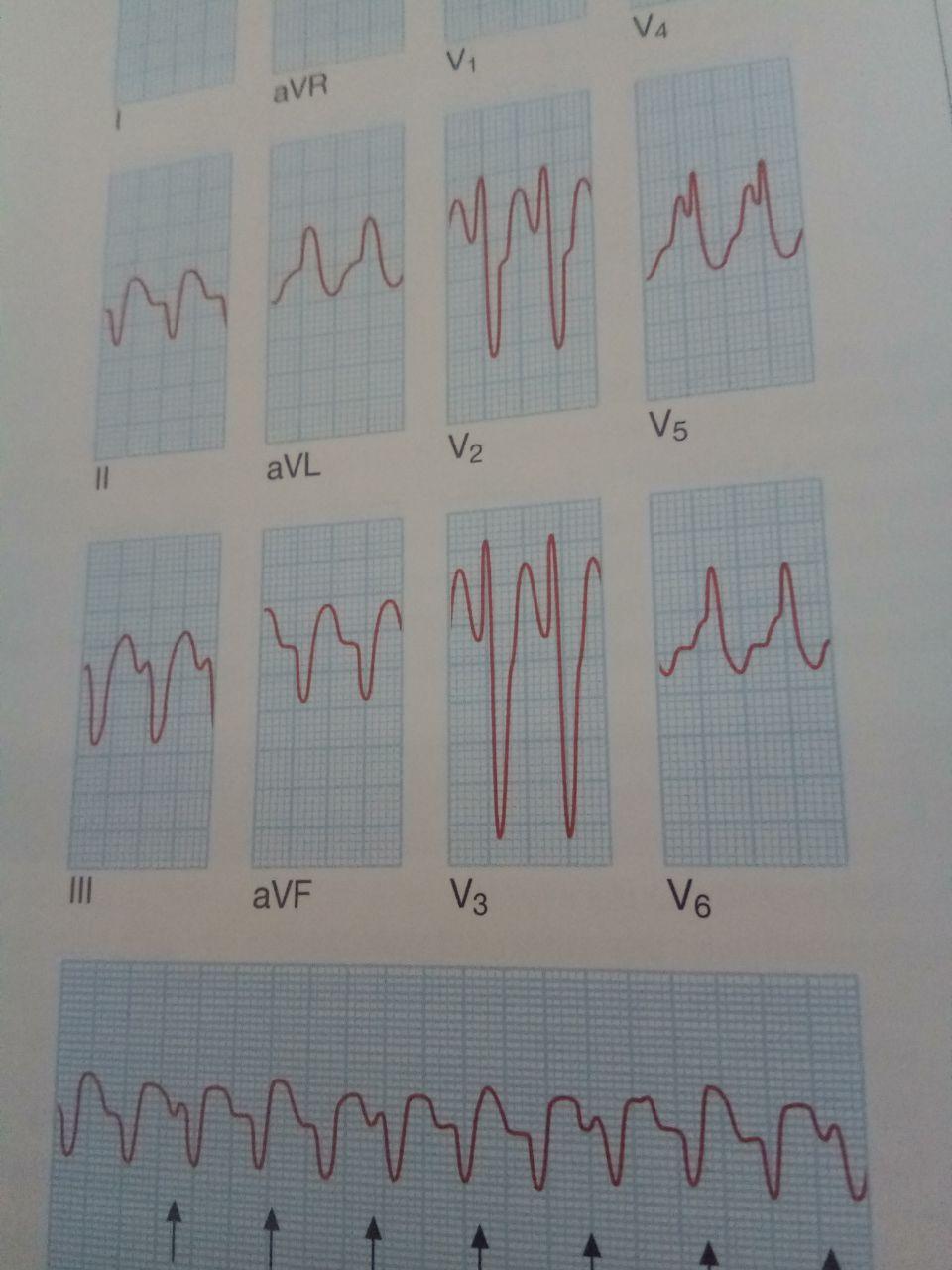 Solved VA V1 aVR M А. // Л. V5 V2 II aVL wu mm III aVF V3 VG | Chegg.com