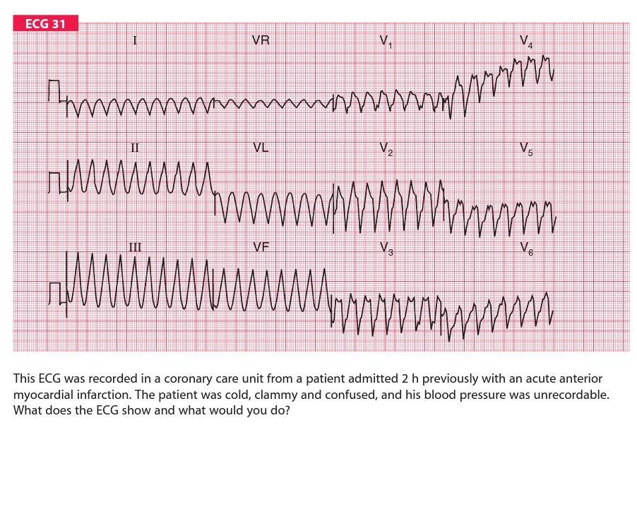Solved ECG 31 1 VR V V ham wwwmarrin II VL V2 V. www. mm III | Chegg.com