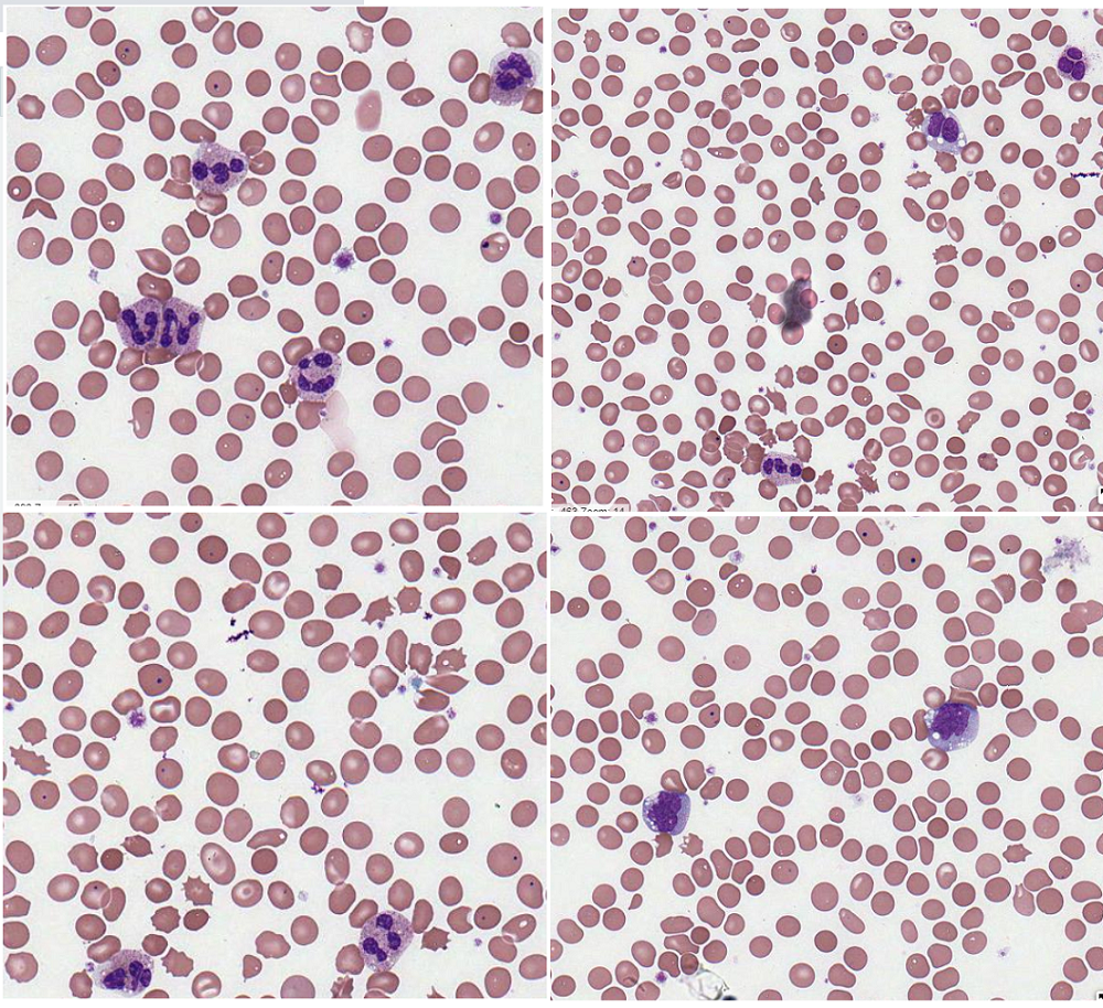 Solved Any abnormal red blood cell morphology? Any Blasts? | Chegg.com