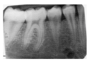 Solved If I am looking at a random bitewing radiograph, what | Chegg.com