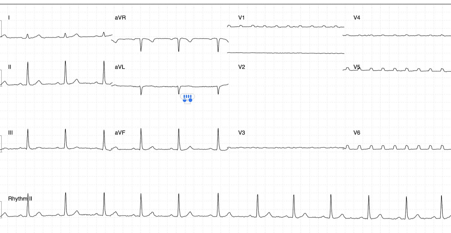 a. ﻿Label the P wave, QRS complex, and T wave for one | Chegg.com