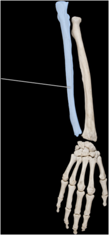 Solved What type of synovial joint is formed between the | Chegg.com