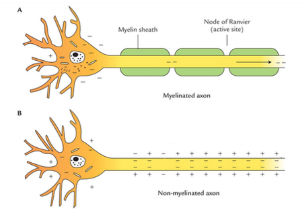 Solved Multiple sclerosis (also known as MS) is a | Chegg.com