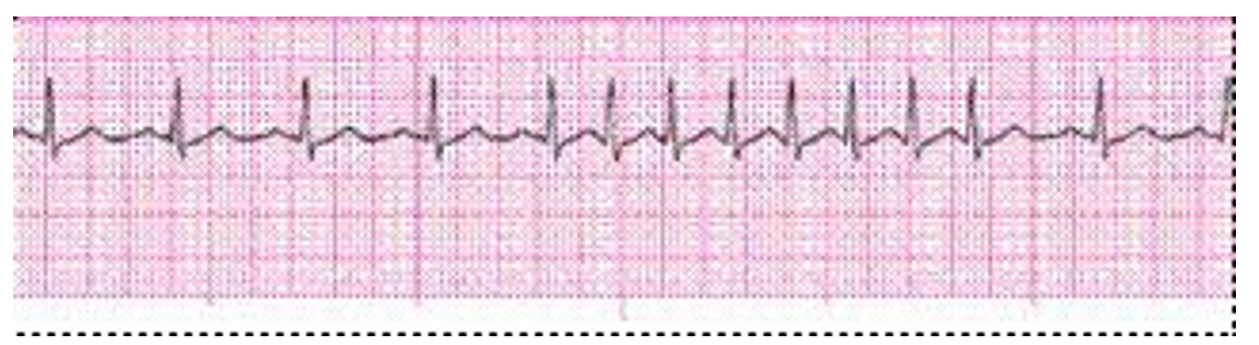 Solved 3) ﻿identify the following rhythm:a)multifocal atrial | Chegg.com