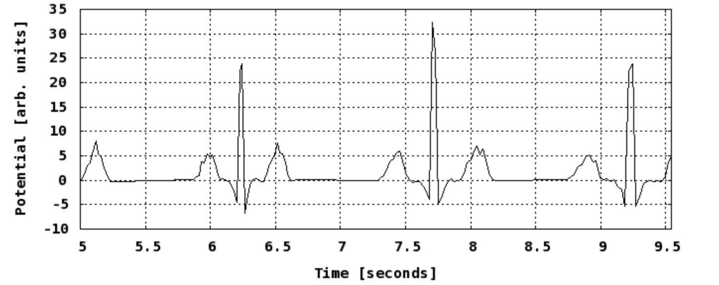 Solved The plot shows an electrocardiogram (EKG) of a | Chegg.com