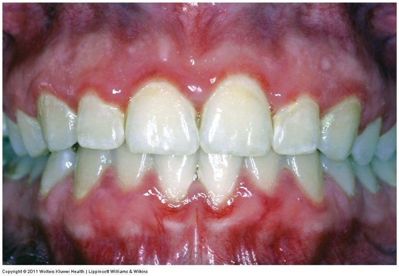 Linear Gingival Erythema