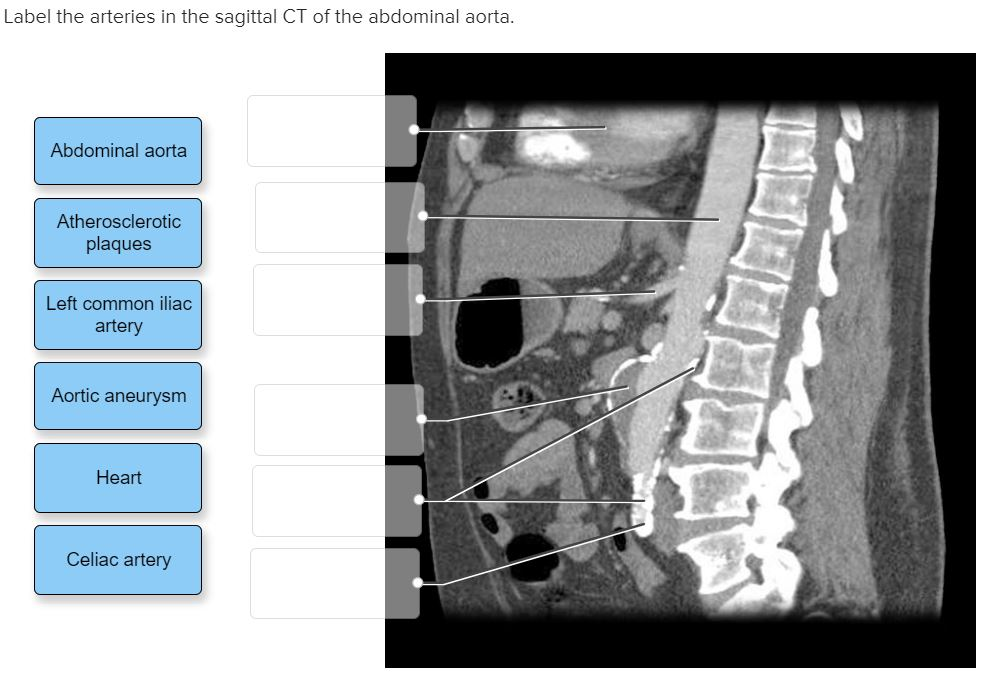 Solved Label the arteries in the sagittal CT of the | Chegg.com
