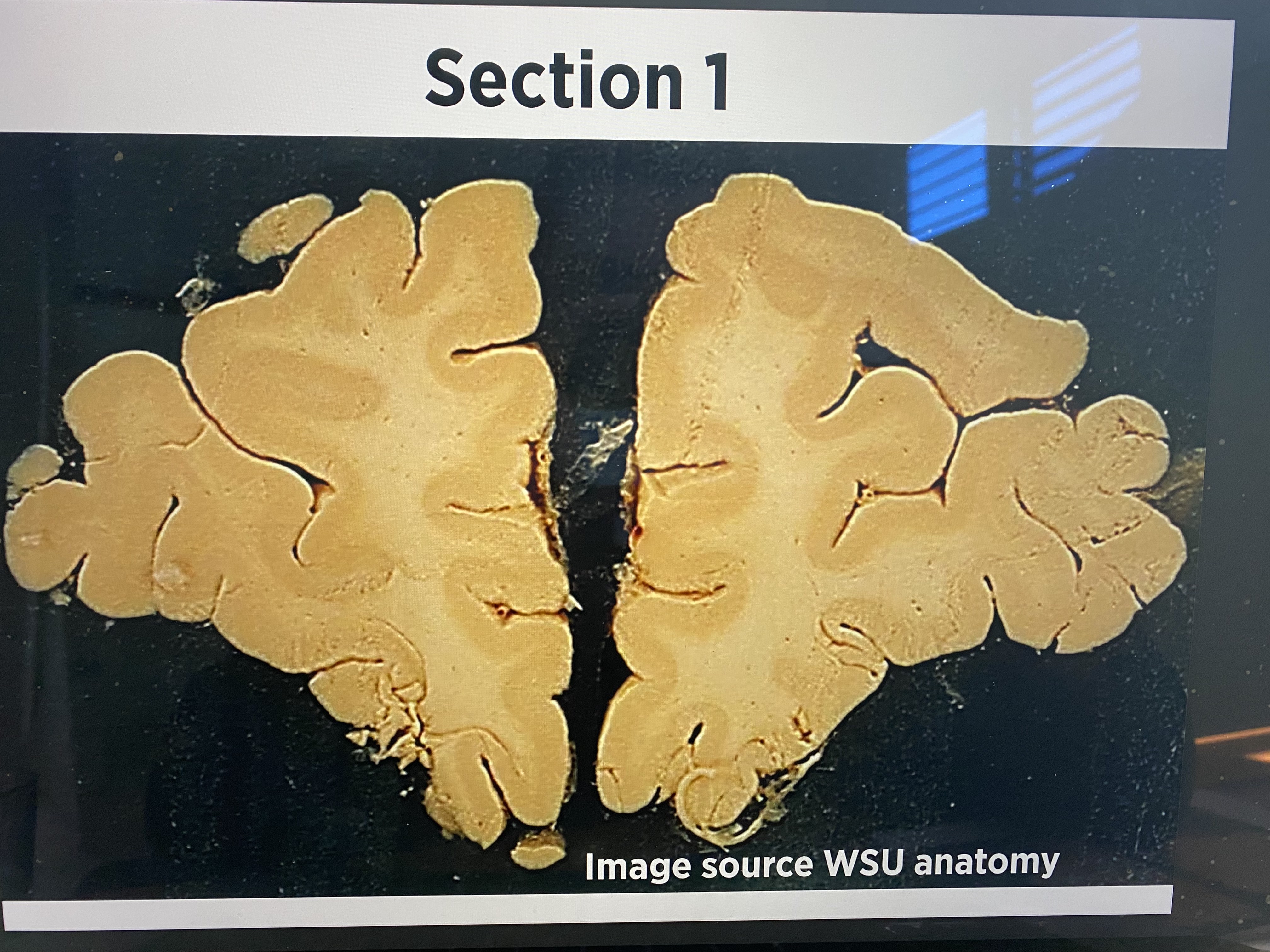 Solved Hello I need a bit of help labeling coronal cuts of | Chegg.com