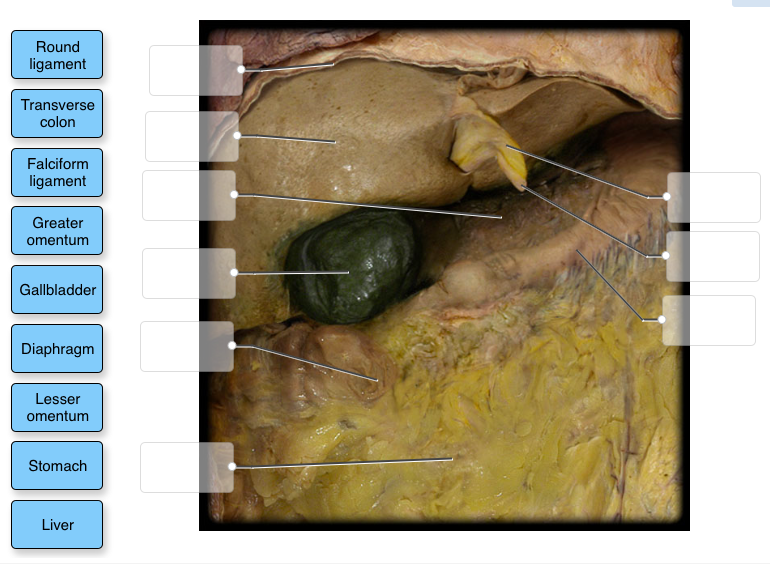 Solved Round ligament Transverse colon Falciform ligament | Chegg.com