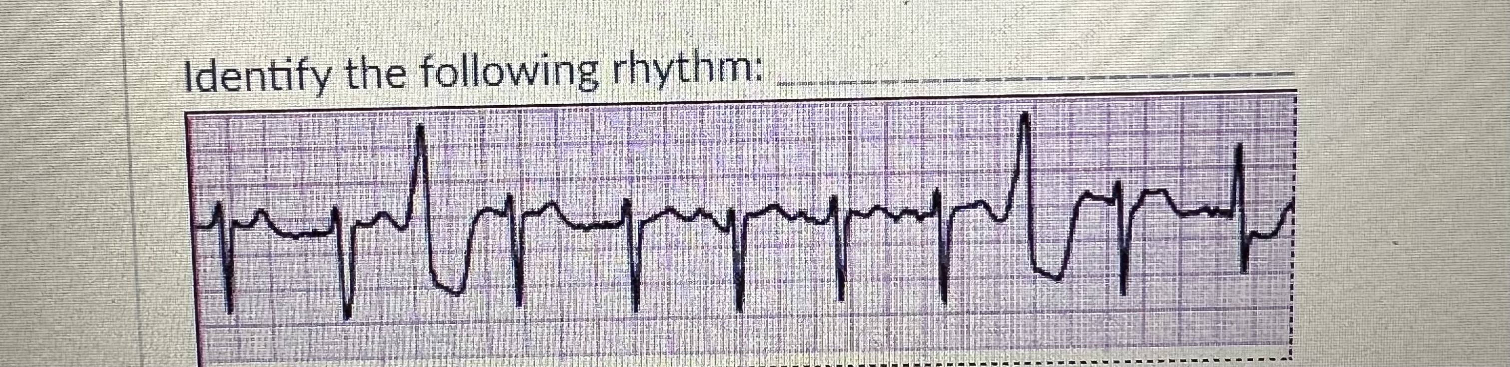 Solved Sinus tachycardia with PAC'sSinus tachycardia with | Chegg.com