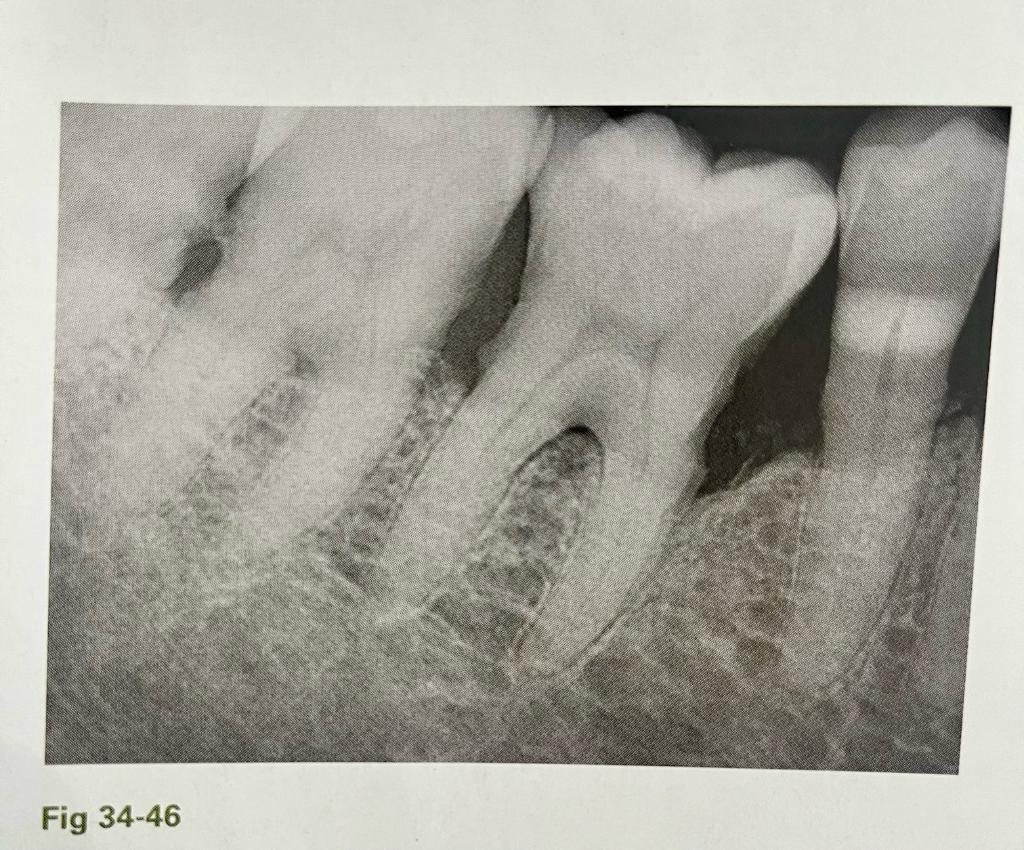 Identify the pattern of, severity of bone loss, and | Chegg.com