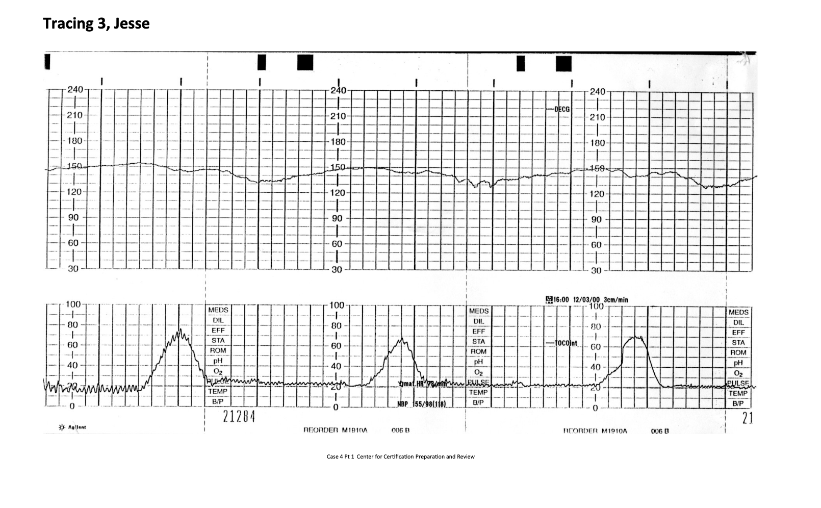 Solved What is the duration of the contractions in Tracing 3 | Chegg.com