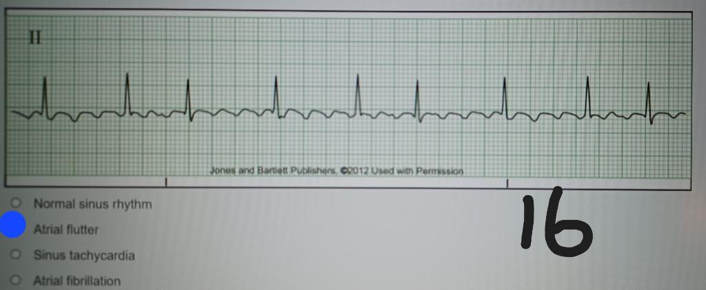 Solved Normal sinus rhythm Atrial fibrillation Atrial | Chegg.com