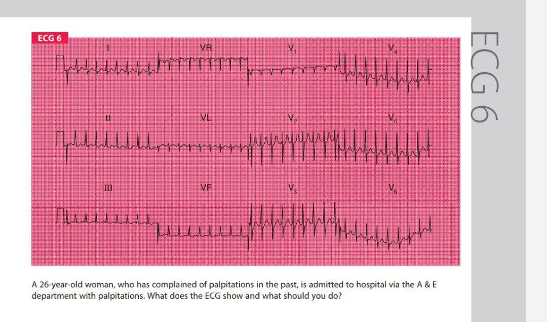 Solved ECG 6 VR V. WWW Tim wa ECG 6 II VL V V Կաները w NA | Chegg.com