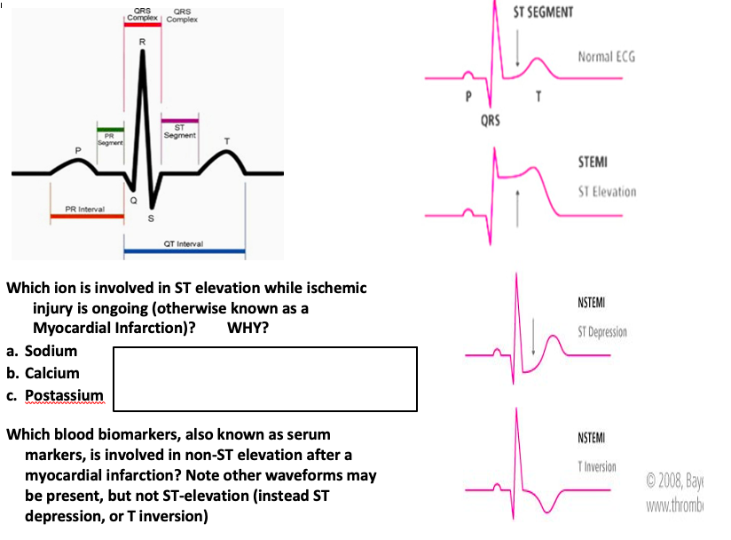 Qrs Inversion