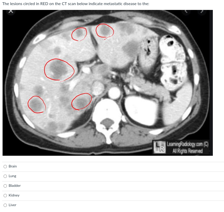 Solved The lesions circled in RED on the CT scan below | Chegg.com