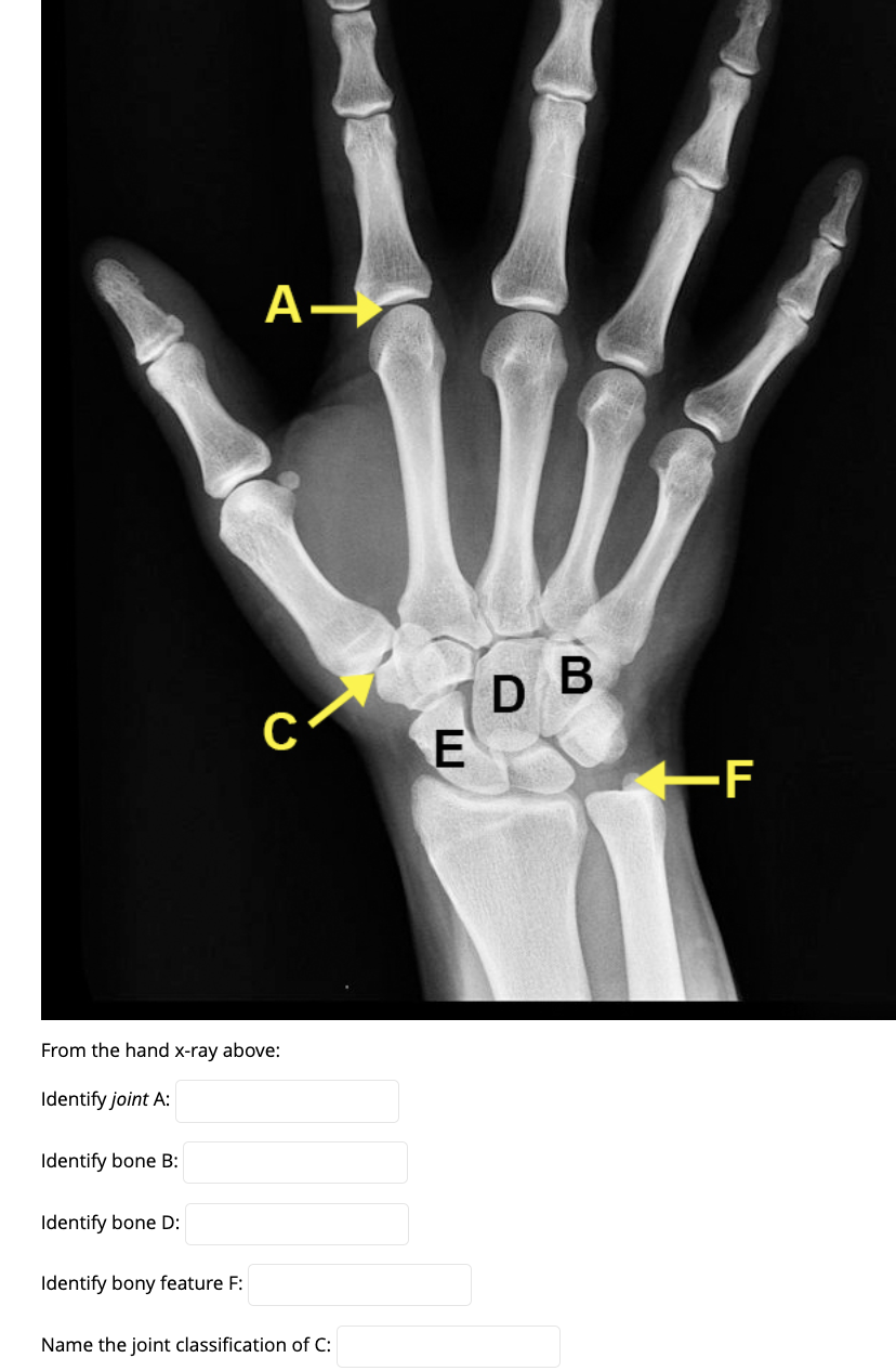 Solved From the hand x-ray above: Identify joint A: Identify | Chegg.com Solved From the hand x-ray above: Identify joint A: Identify | Chegg.com