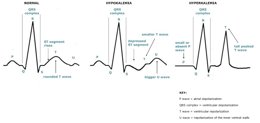 Hypokalemia Hyperkalemia Ecg