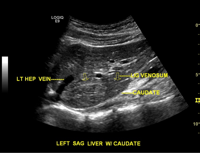 Caudate Lobe Of Liver Ultrasound