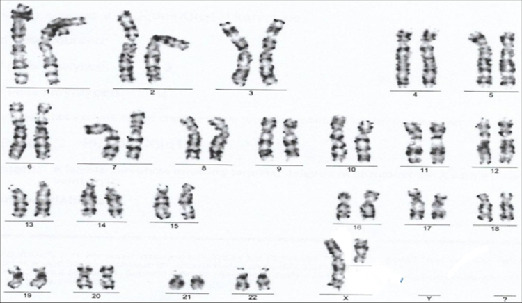 Solved Name the following chromosomal abnormailities and | Chegg.com