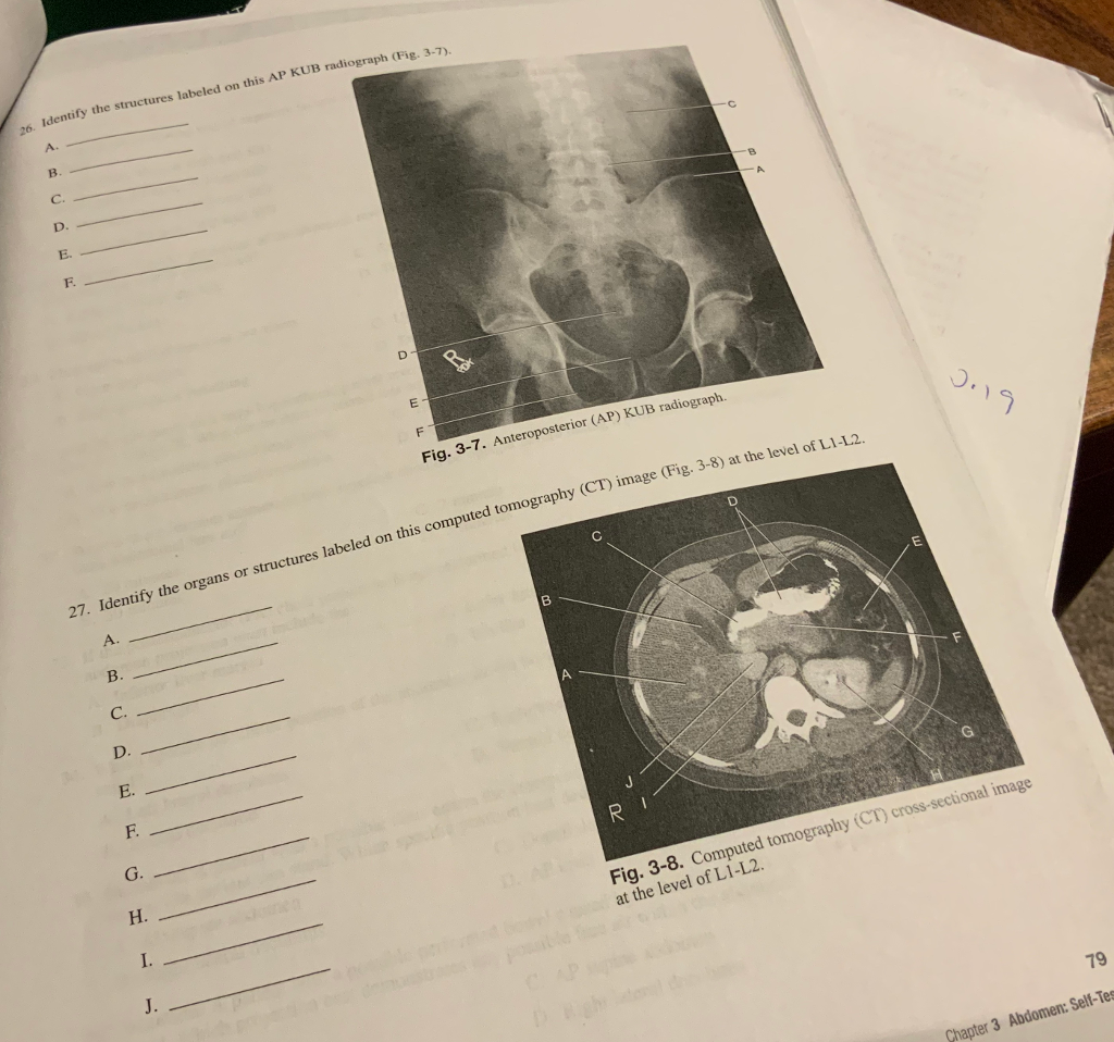Solved Identify the structures labeled on this AP KUB | Chegg.com