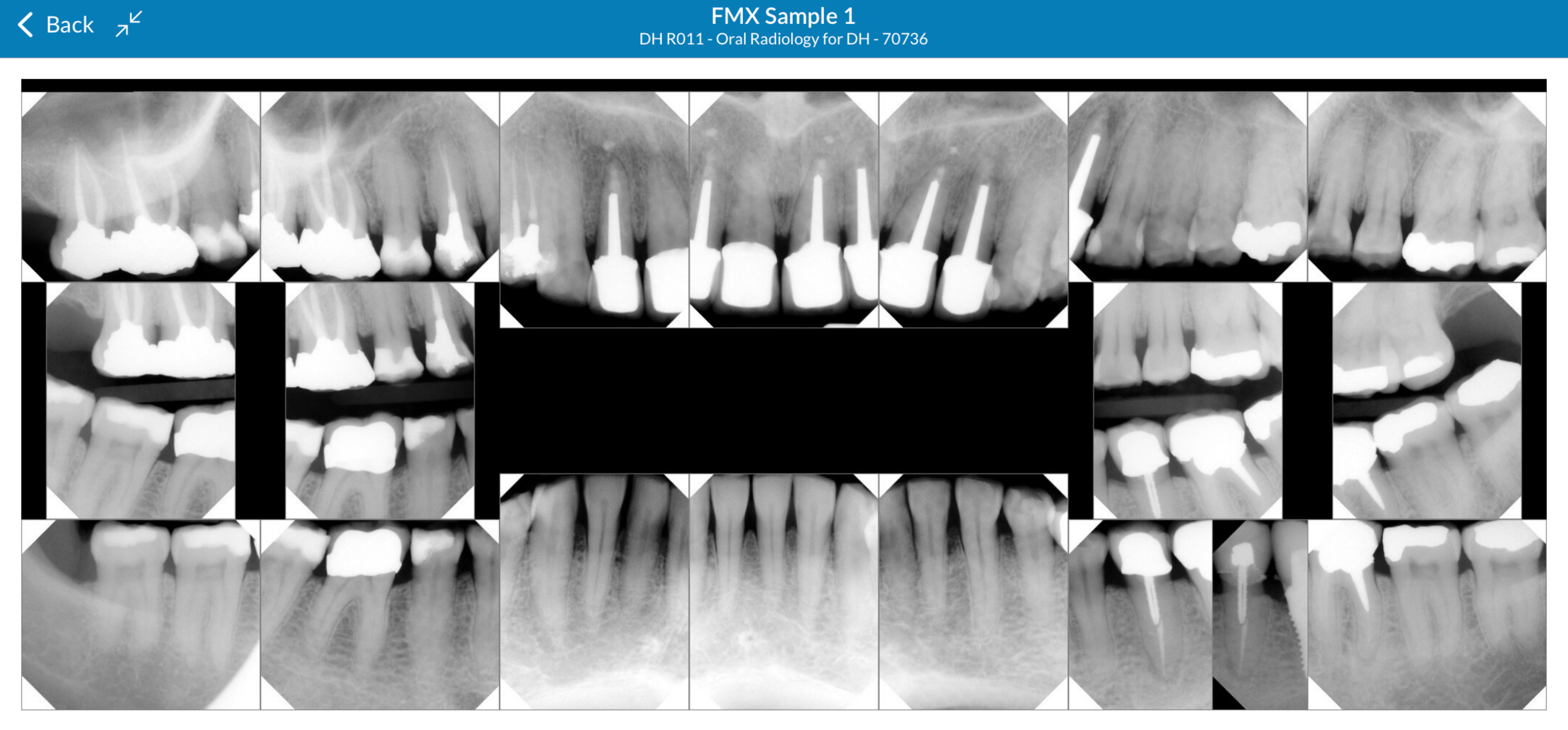Solved Identify all missing teeth, pathology and | Chegg.com