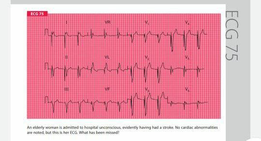 Solved ECG 25 VR ECG 75 དེ །པའི་ས་ལ་ས་ནས། ། ཡན། ༩༽ ། | Chegg.com