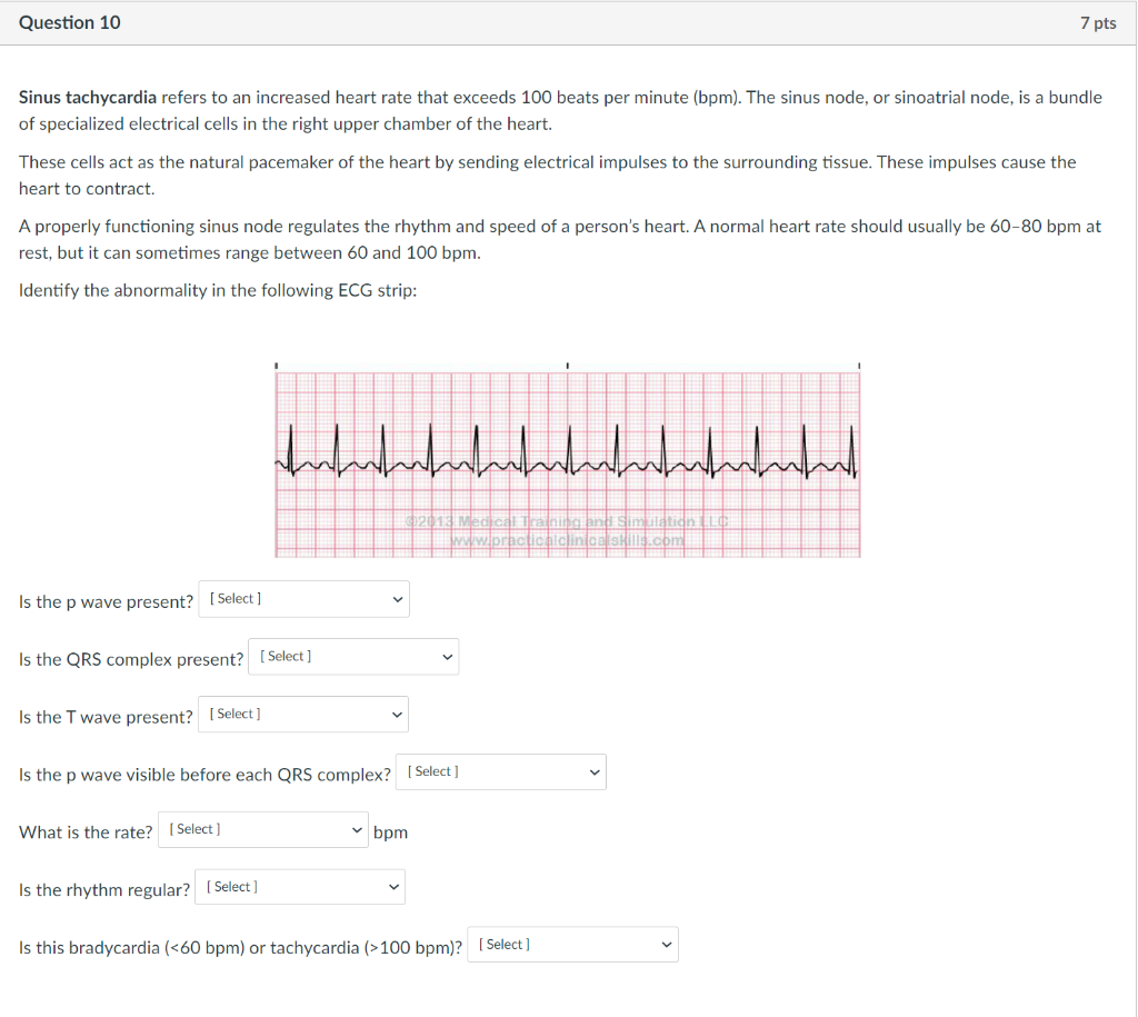 Solved Question 10 7 pts Sinus tachycardia refers to an | Chegg.com