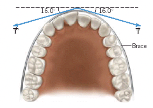 Solved The drawing shows a wire tooth brace used by | Chegg.com