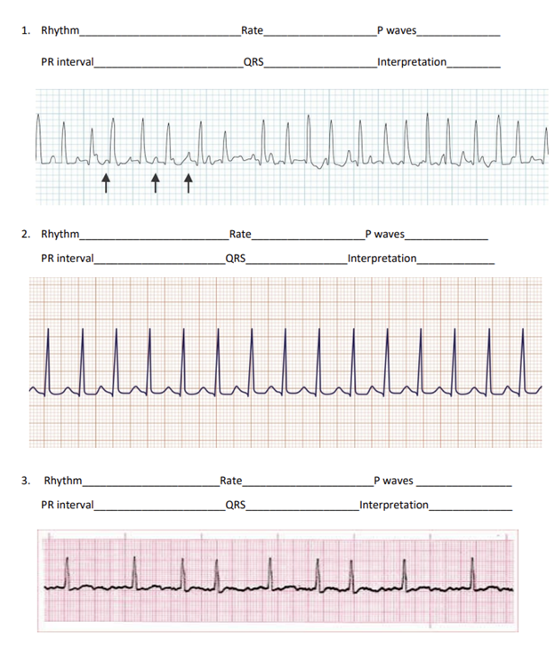 Solved 1. Rhythm Rate P Waves PR interval QRS | Chegg.com