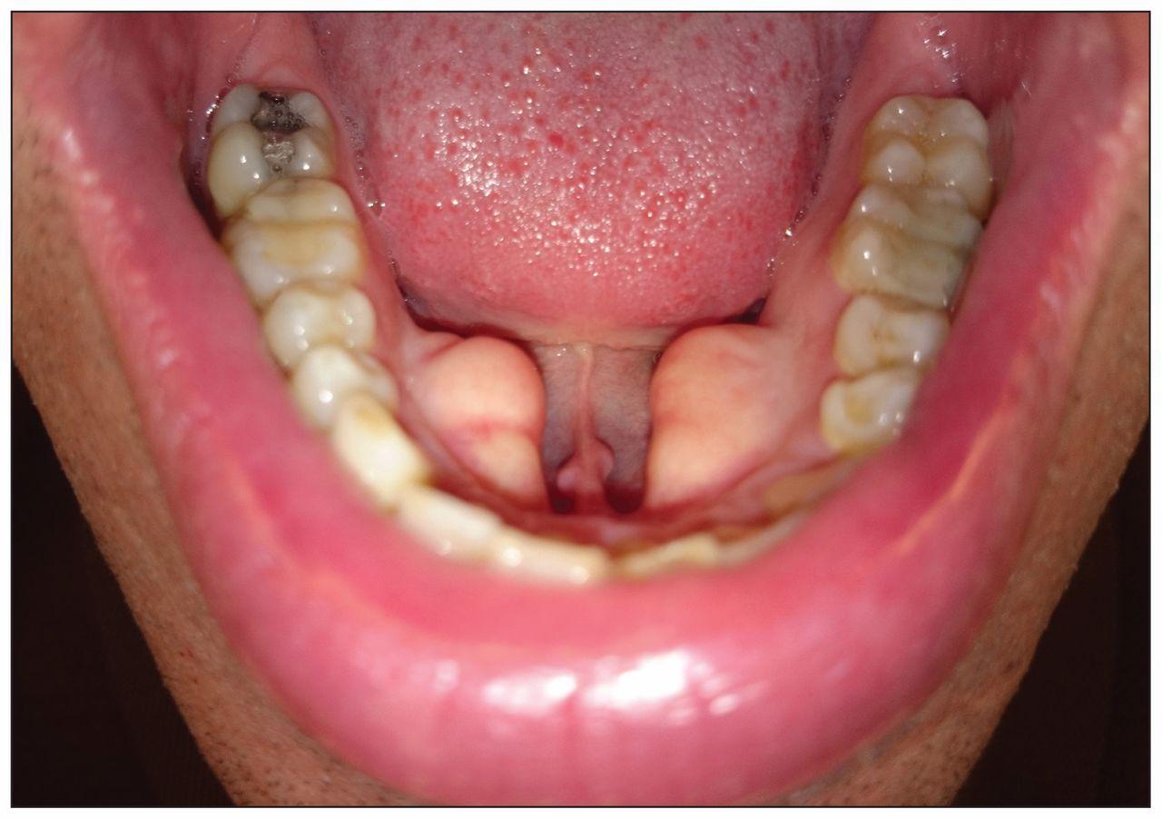 Syphilis Snail Track Ulcers