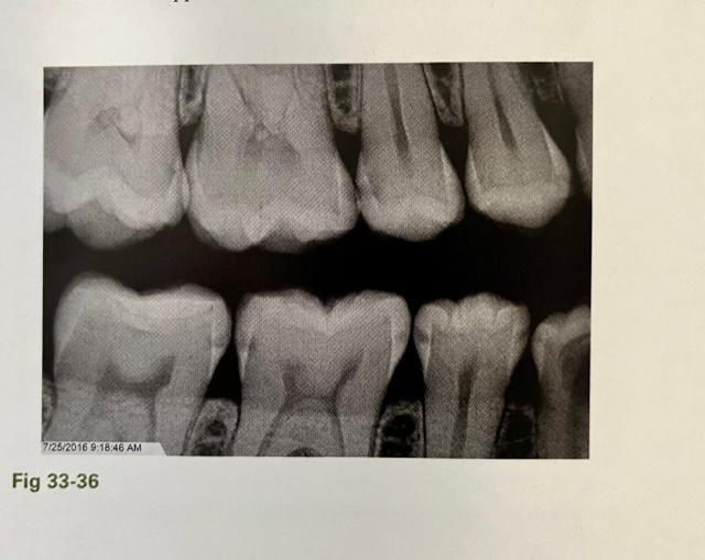 Solved In figure 33-36, examine the mesial and distal | Chegg.com