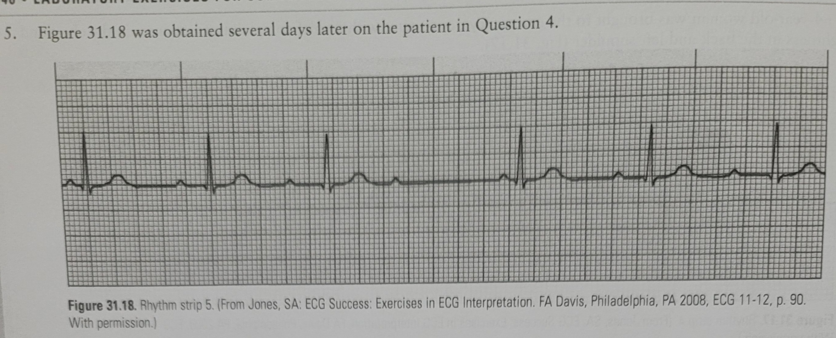 Solved A) Rate:B) Rhythm: regular or irregular?C) P waves: | Chegg.com