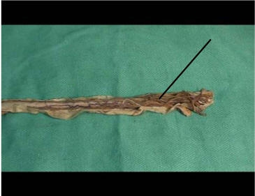 Solved This structure is the filum terminale. What is it | Chegg.com