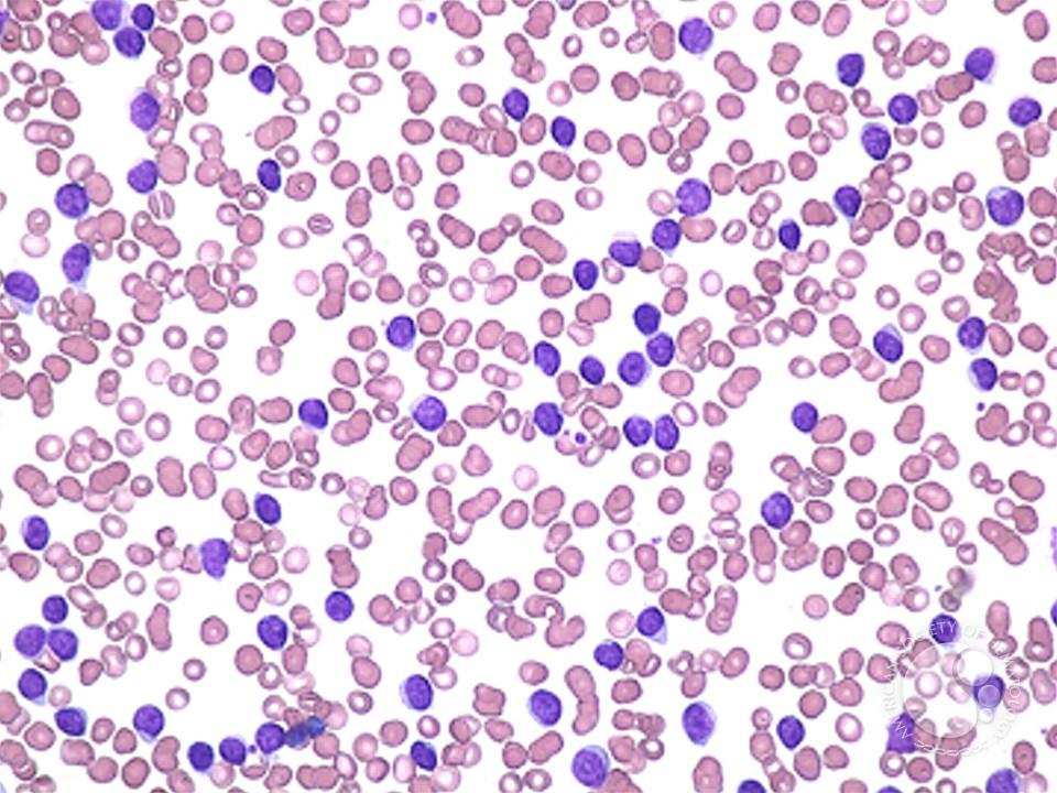 Solved A 71-year-old male presented to his physician with a | Chegg.com