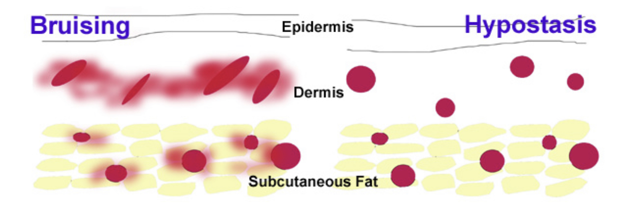 Solved Bruising Epidermis Hypostasìs Dermis Subcutaneous Fat | Chegg.com