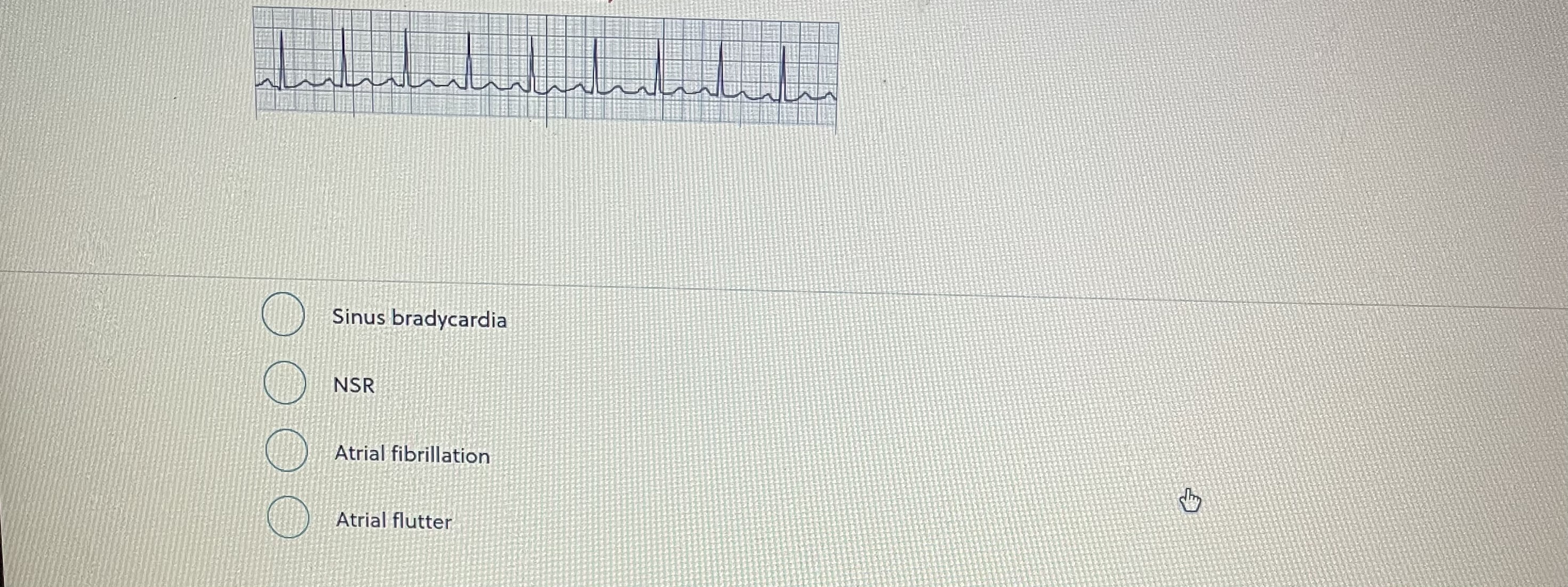 Solved Sinus bradycardia NSR Atrial fibrillation Atrial | Chegg.com