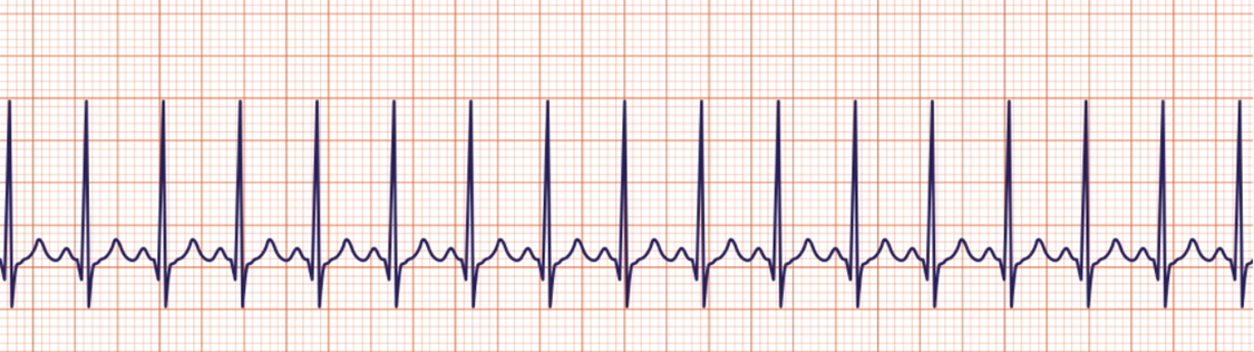 Solved Peak Exercise EKG - circle the correct answer or fill | Chegg.com