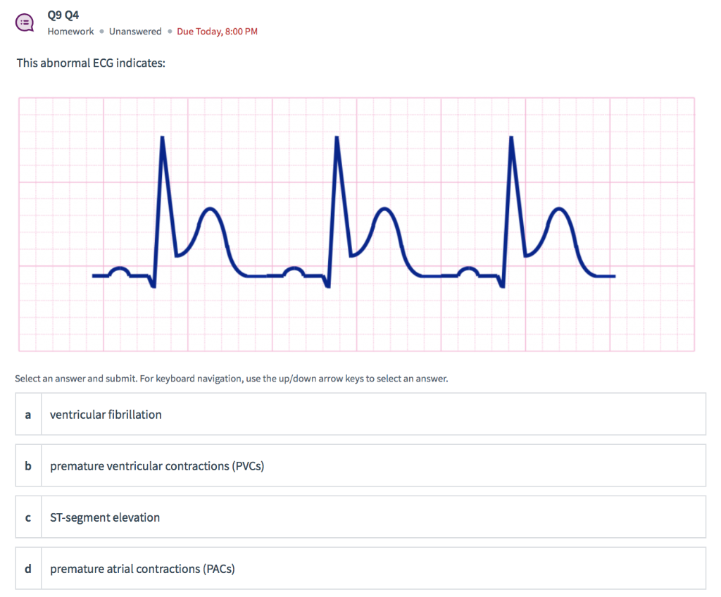 Solved This Abnormal Ecg Indicates Select An Answer And